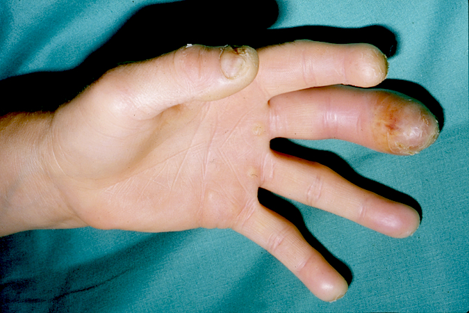 FELON FINGER | Hand Surgery Resource